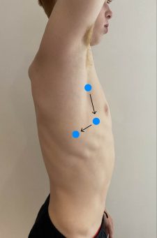 Posterior and Lateral Thorax – Percussion – Introduction to Health ...
