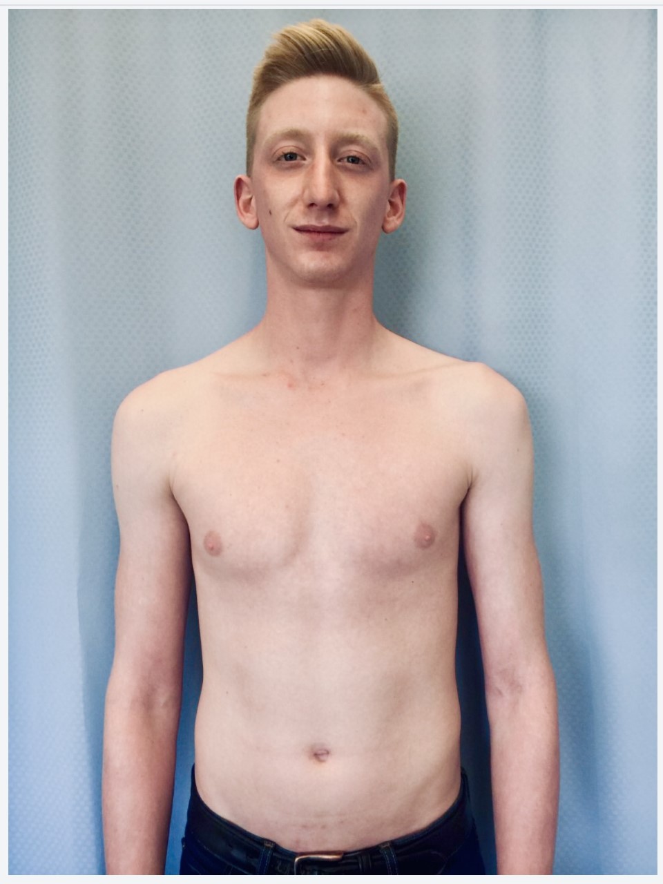 Posterior and Lateral Thorax – Inspection – Introduction to Health ...