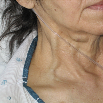 Jugular Veins – Introduction to Health Assessment for the Nursing ...