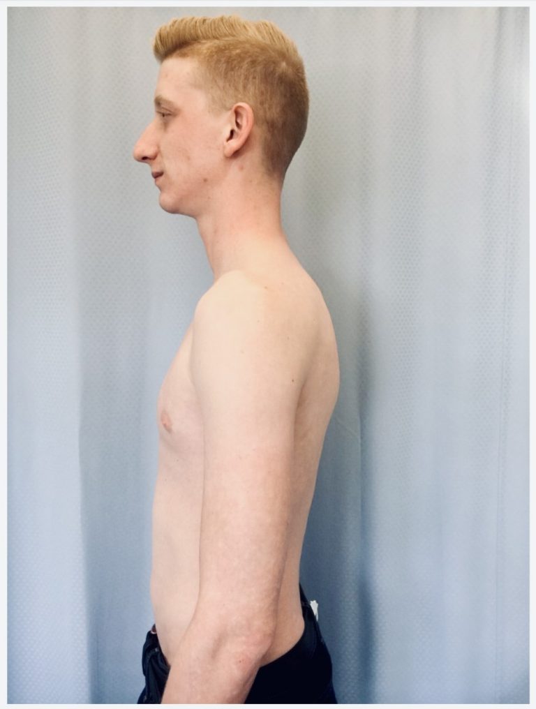 Posterior and Lateral Thorax – Inspection – Introduction to Health ...