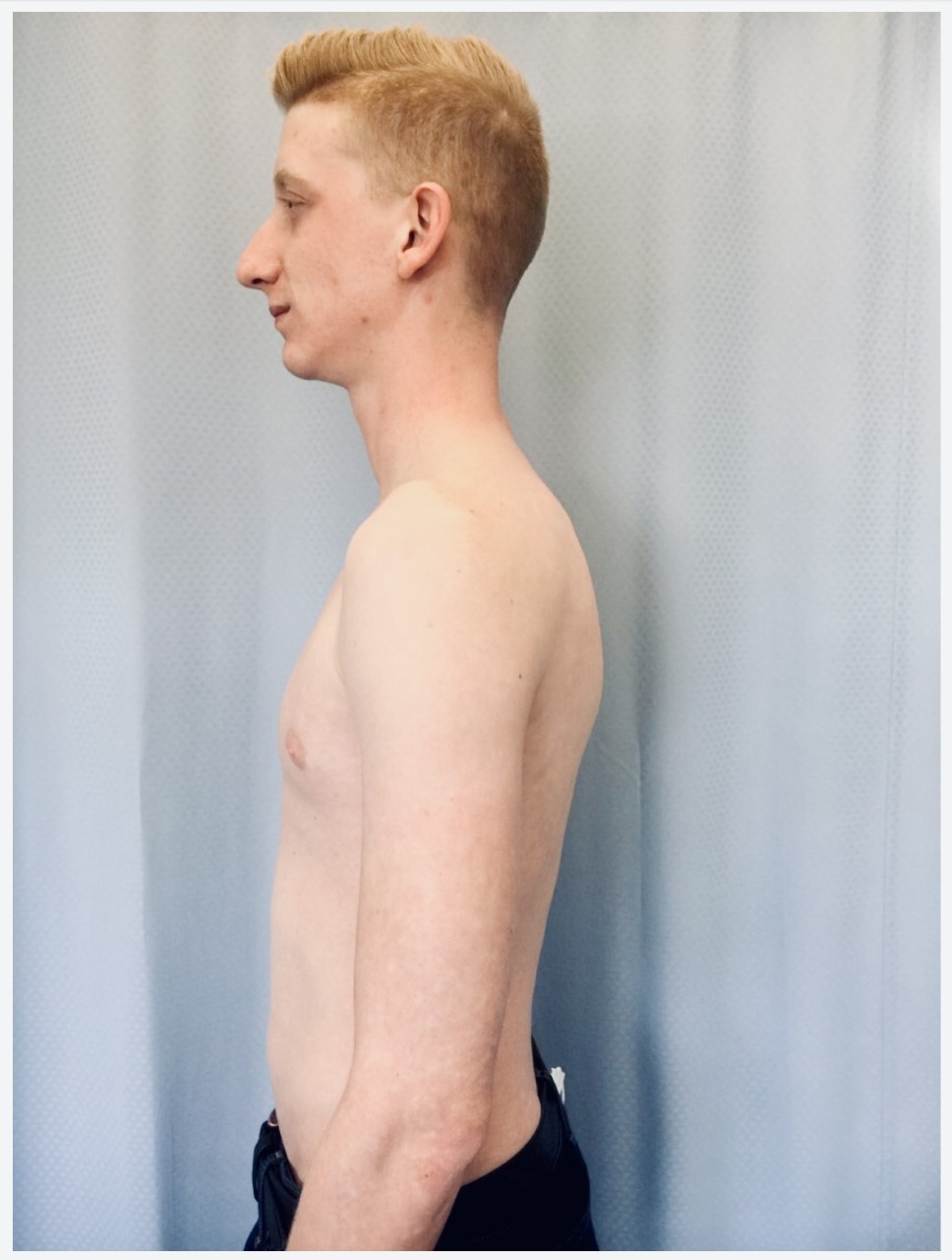 Posterior and Lateral Thorax – Inspection – Introduction to Health ...