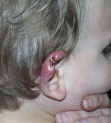 Inspection and Palpation of External Ear – Introduction to Health ...