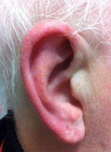 Inspection and Palpation of External Ear – Introduction to Health ...