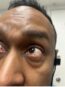 External Eye Assessment and Anterior Eyeball Assessment – Introduction ...