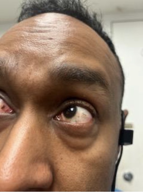 External Eye Assessment and Anterior Eyeball Assessment – Introduction ...