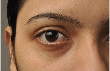 External Eye Assessment and Anterior Eyeball Assessment – Introduction ...